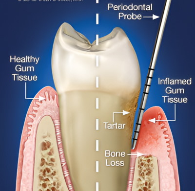 Periodontics Batavia NY, Hornell, Geneseo New York