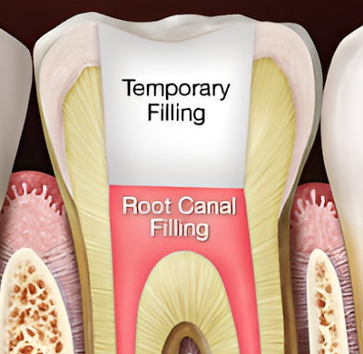 Endodontics Geneseo NY | Endodontist Batavia | Root Canal Specialists